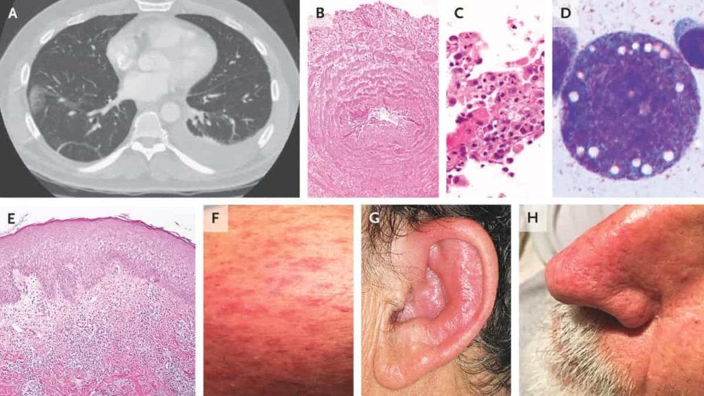 Há 10 casos de VEXAS em Portugal. Que síndrome é esta?
